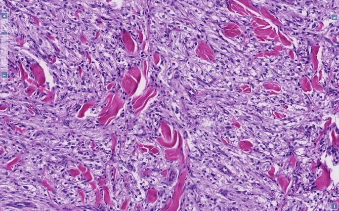 Primary Cutaneous PEComa | Pathology Resident Wiki | Fandom