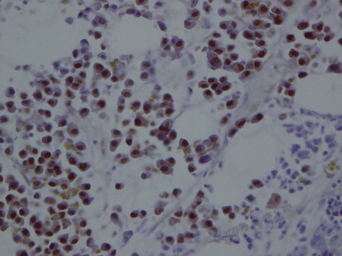MUM1 (IRF4) | Pathology Resident Wiki | Fandom