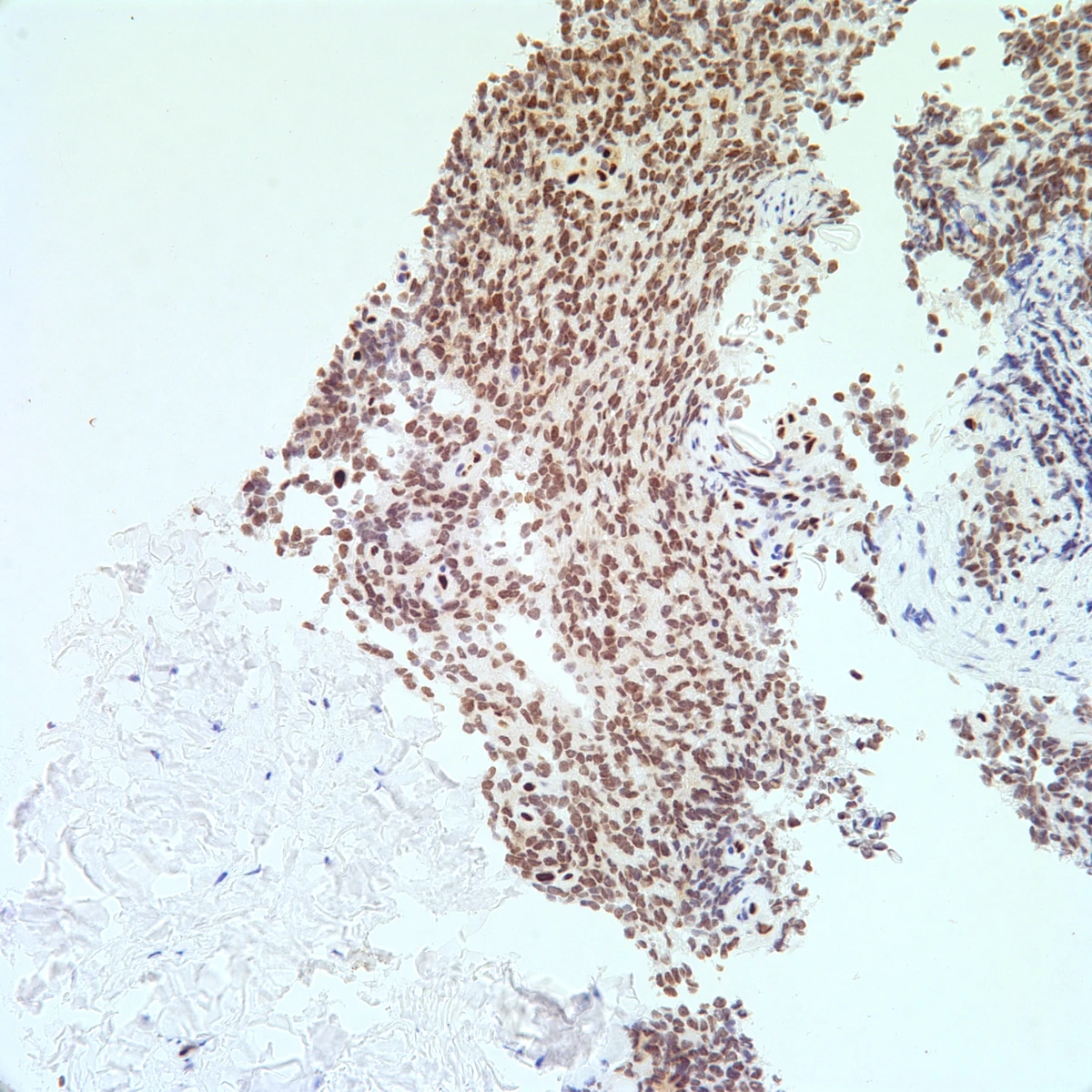 FLI-1 | Pathology Resident Wiki | Fandom