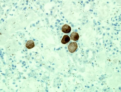 Cytomegalovirus (CMV) | Pathology Resident Wiki | Fandom