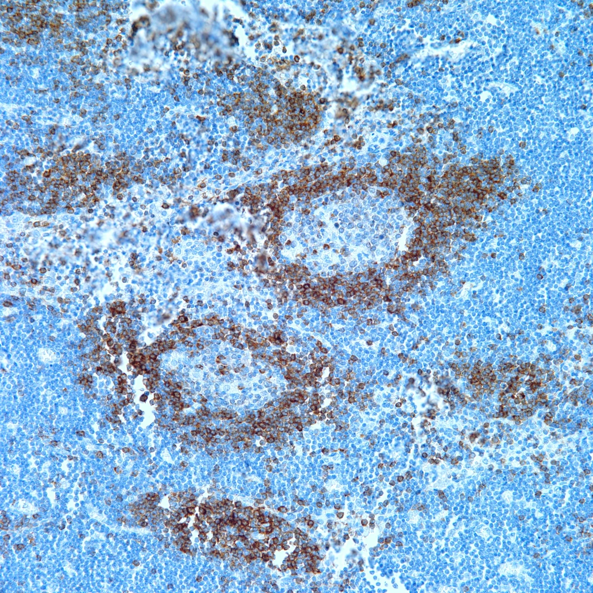 CD79a | Pathology Resident Wiki | Fandom