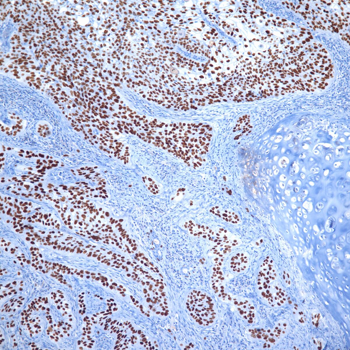P63 | Pathology Resident Wiki | Fandom