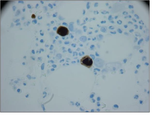 Parvovirus B19 | Pathology Resident Wiki | Fandom