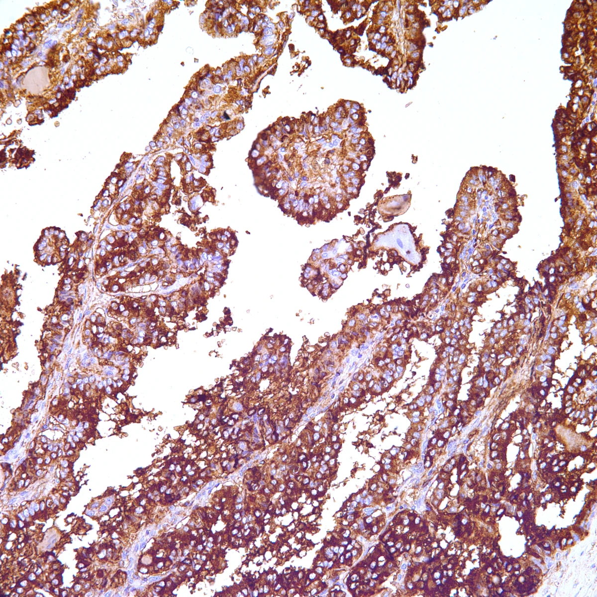 Thyroglobulin | Pathology Resident Wiki | Fandom