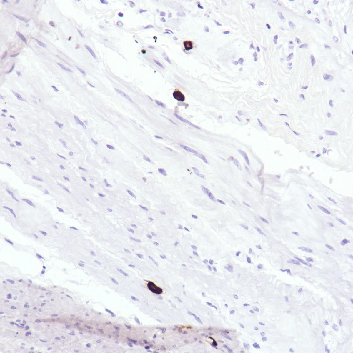 Tryptase | Pathology Resident Wiki | Fandom