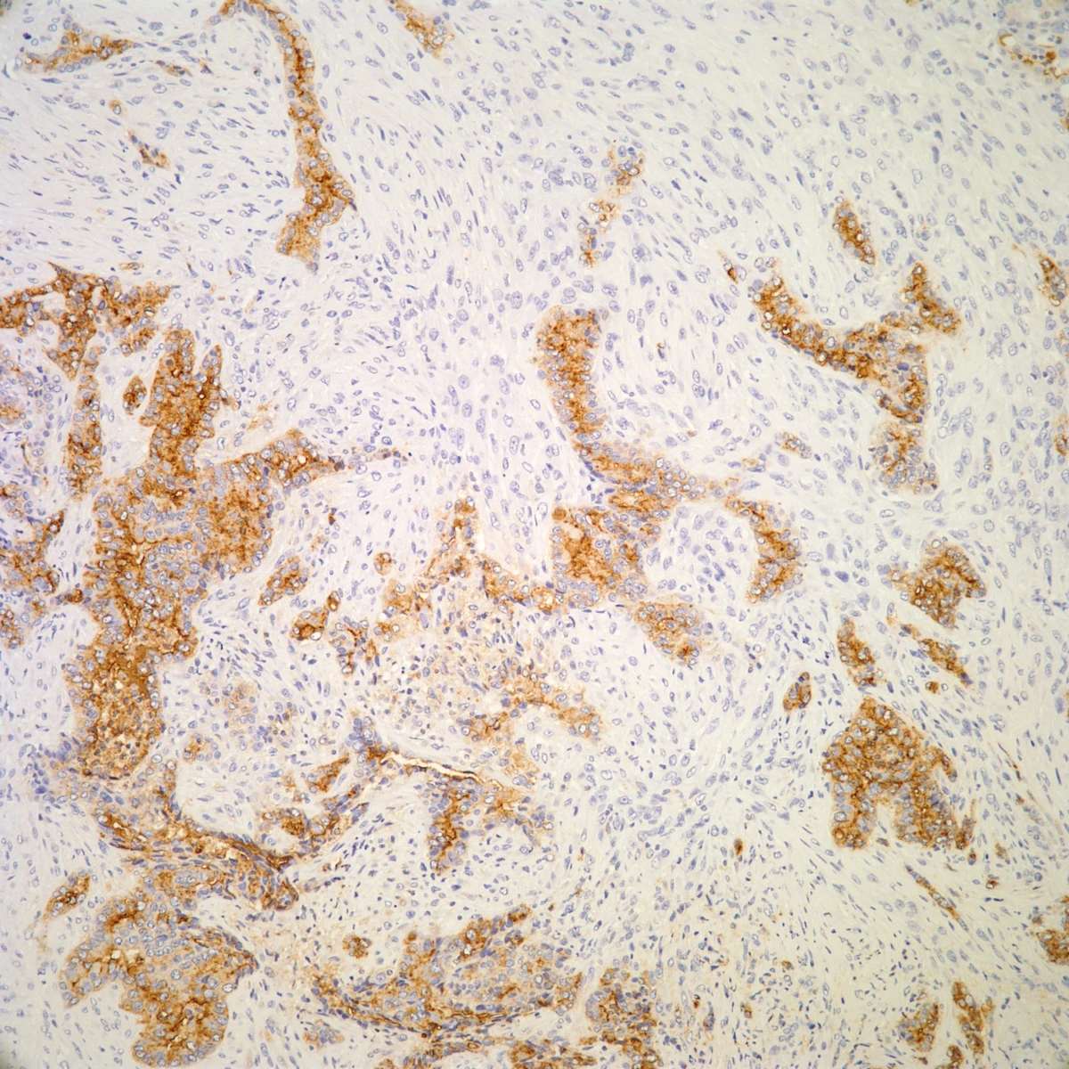 HBME-1 | Pathology Resident Wiki | Fandom