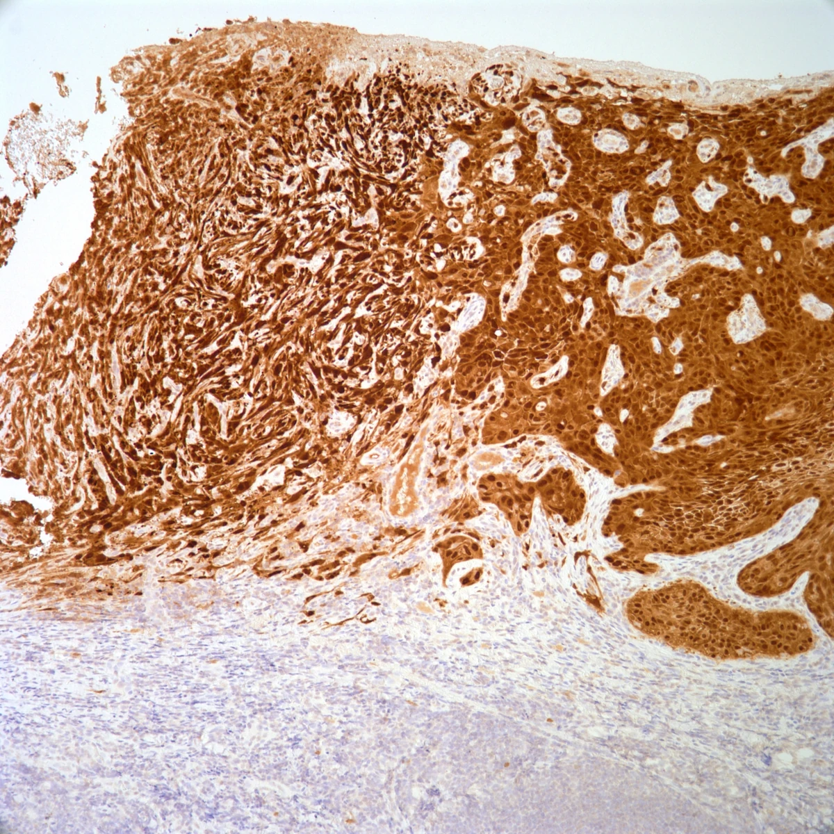 P16 (p16INK4) | Pathology Resident Wiki | Fandom