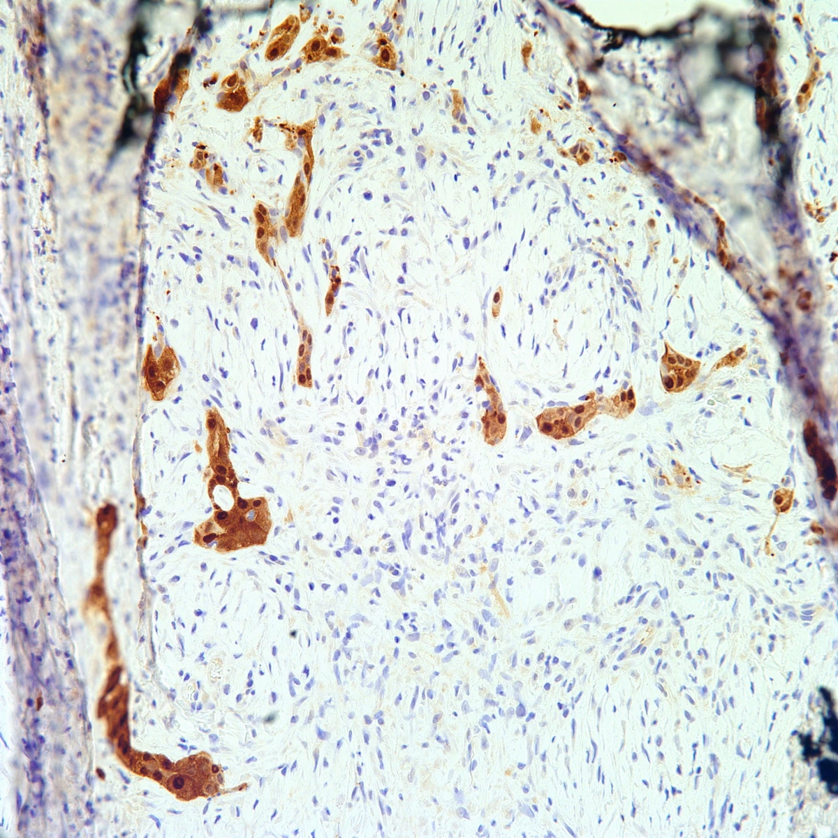 Calretinin | Pathology Resident Wiki | Fandom