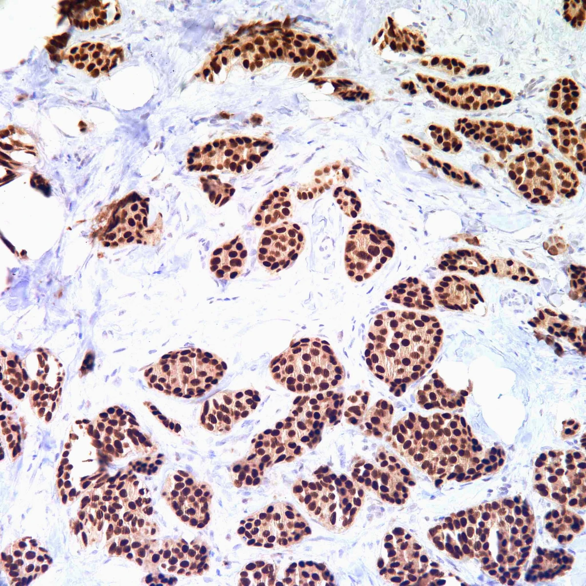 Estrogen Receptor (ER) | Pathology Resident Wiki | Fandom