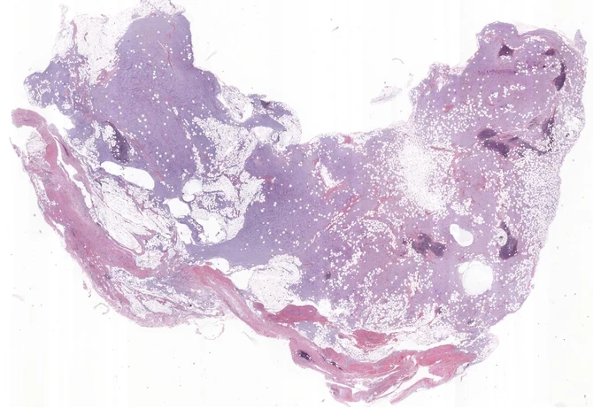 Pretibial Myxedema with Intramuscular Soft Tissue Involvement in a ...