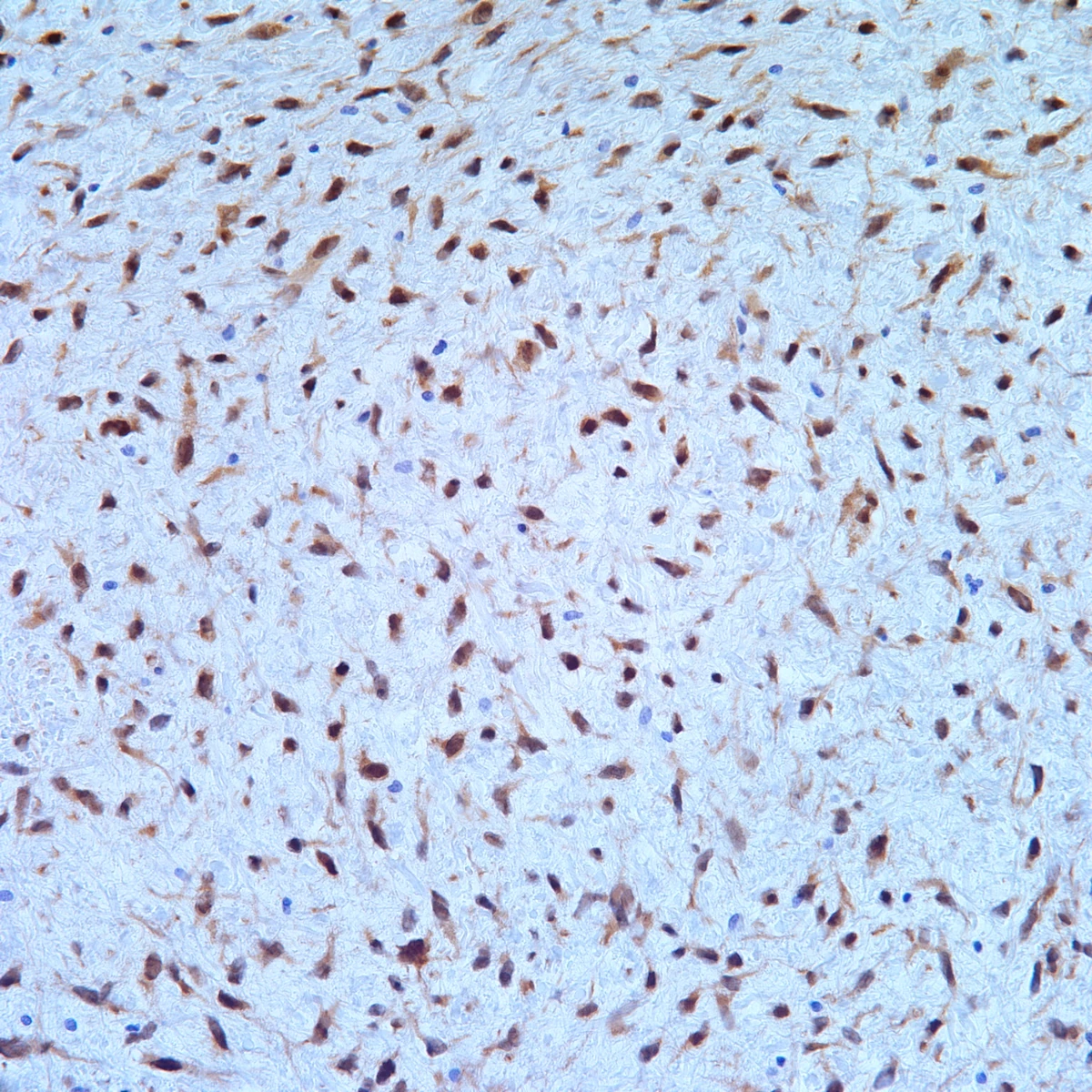 CDK4 | Pathology Resident Wiki | Fandom