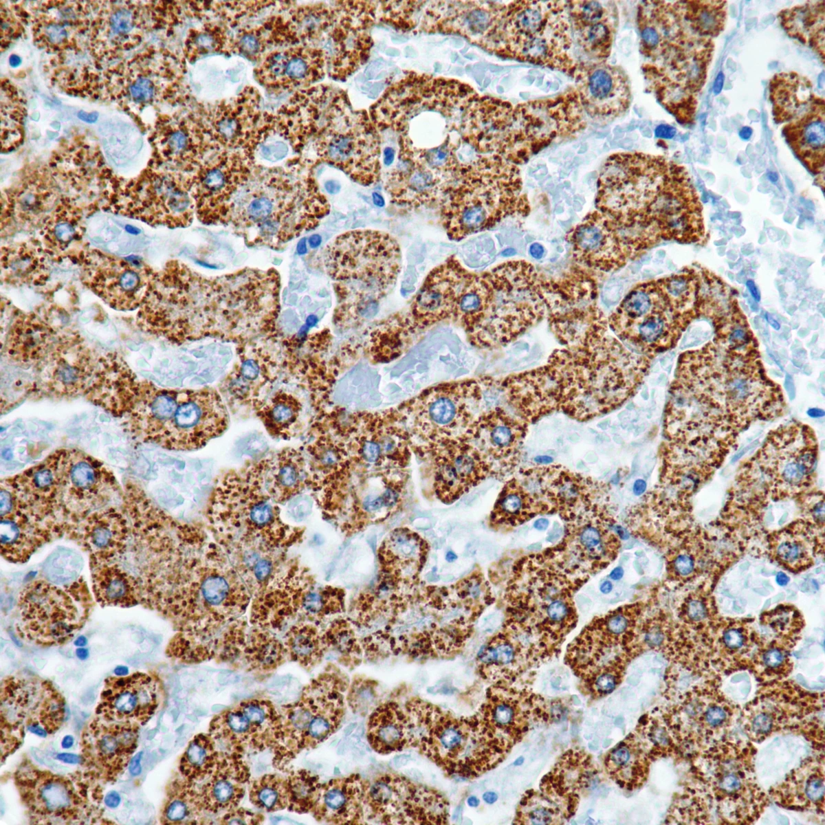 Hepatocyte Paraffin 1 (Hep Par 1) | Pathology Resident Wiki | Fandom