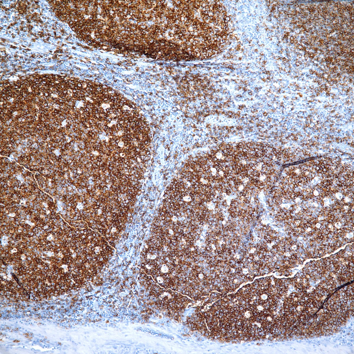 CD20 | Pathology Resident Wiki | Fandom