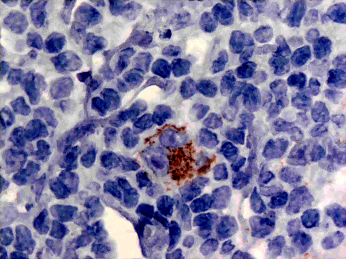 CD15 | Pathology Resident Wiki | Fandom