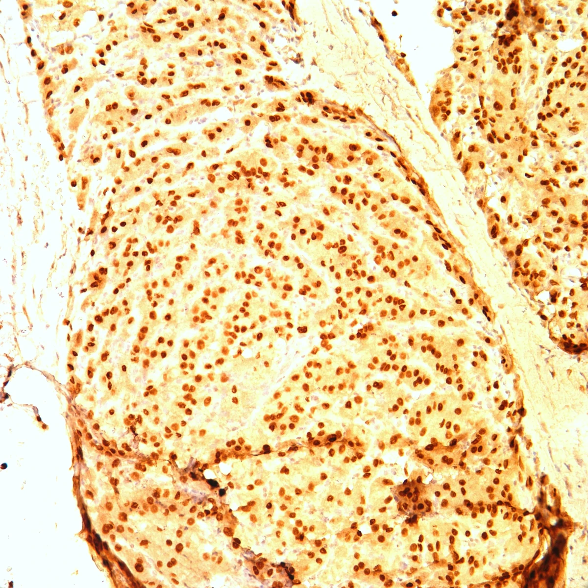 TFE3 | Pathology Resident Wiki | Fandom