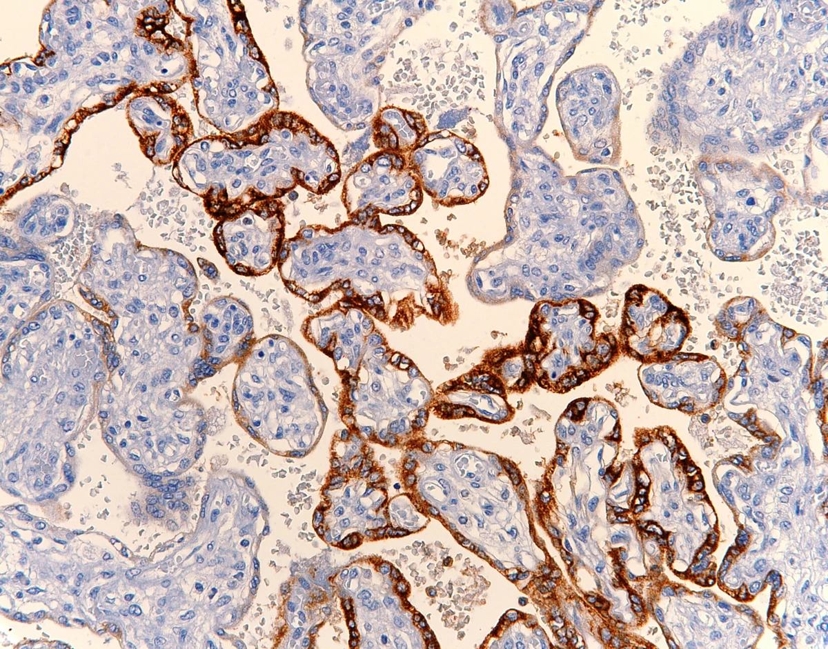 Human Chorionic Gonadotropin (HCG) | Pathology Resident Wiki | Fandom