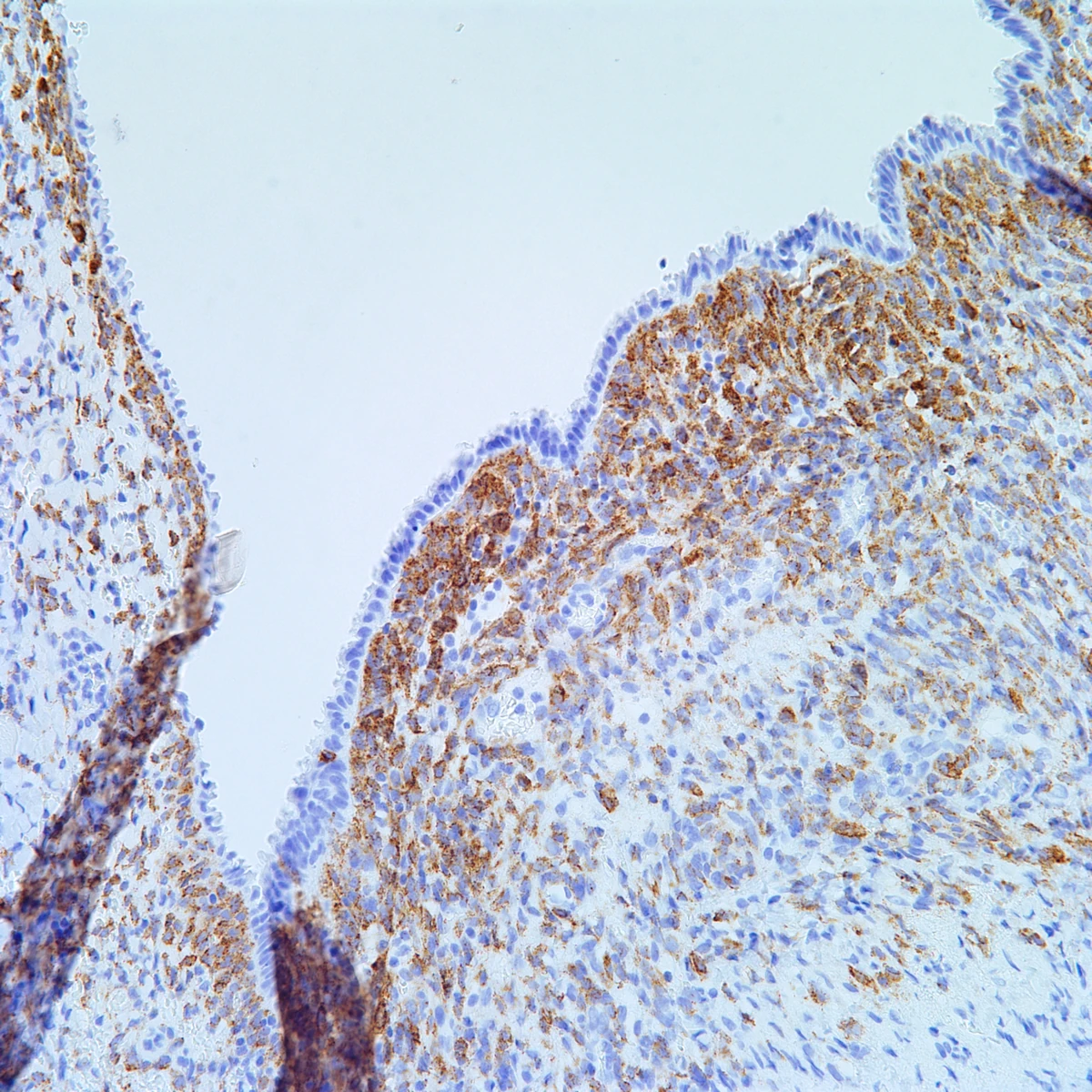 HMB-45 | Pathology Resident Wiki | Fandom
