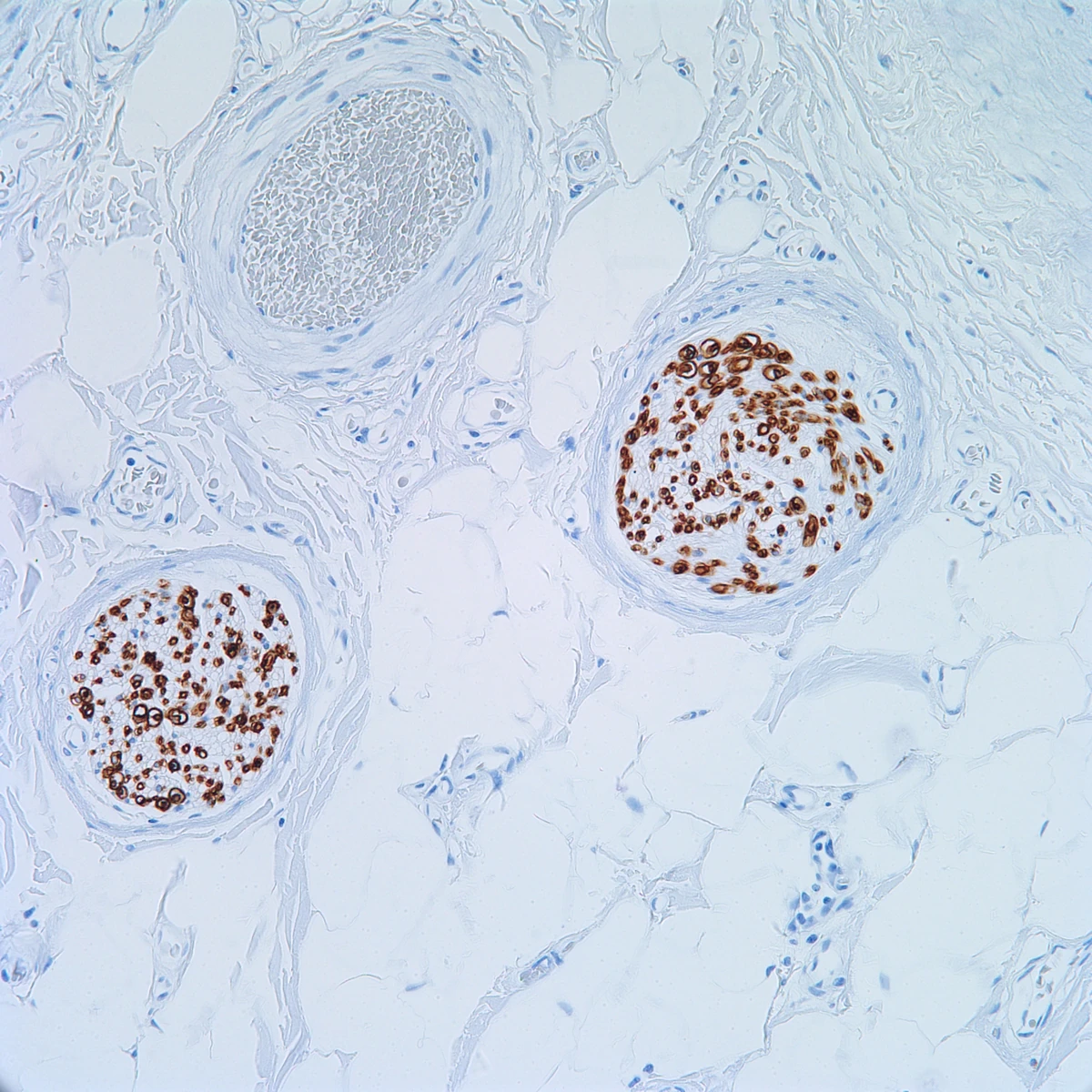 CD57 | Pathology Resident Wiki | Fandom
