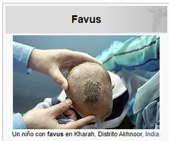 Micosis (B35-B49) | Patología clínica Wiki | Fandom