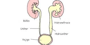 Hidronefrosis | Patología clínica Wiki | Fandom