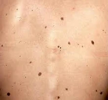 Nevus | Patología clínica Wiki | Fandom