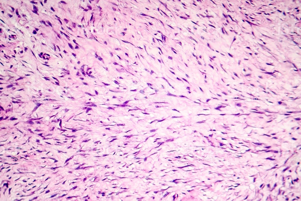 Fibroma | Patología clínica Wiki | Fandom