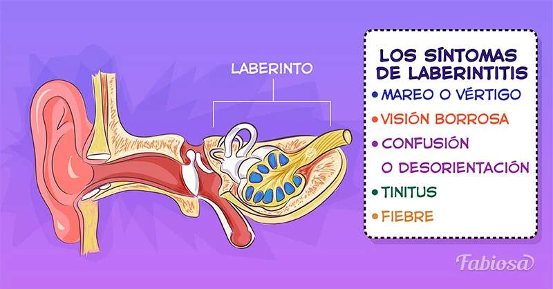(H83.0) Laberintitis | Patología clínica Wiki | Fandom