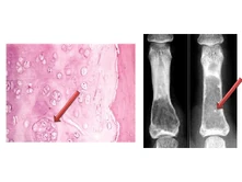 Condroma | Patología clínica Wiki | Fandom