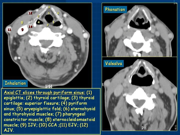 3.2.1.4: Pyriform recess/sinus/fossa | RadAnatomy Wiki | Fandom