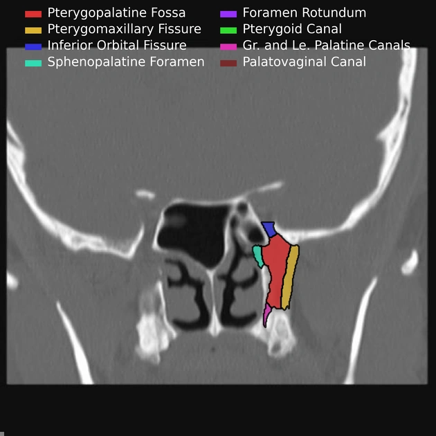 1.4.1.16: Pterygopalatine Fossa / Sphenopalatine Fossa / PPF ...