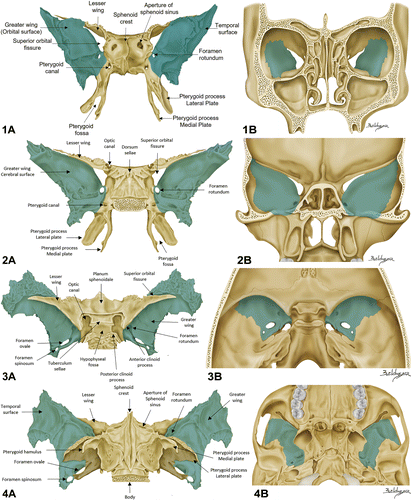 1121 The Sphenoid Bone Greater Wing And Sinus Radanatomy Wiki Fandom