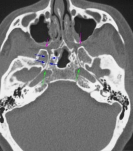 1.1.2.9: Vidian Canal | RadAnatomy Wiki | Fandom