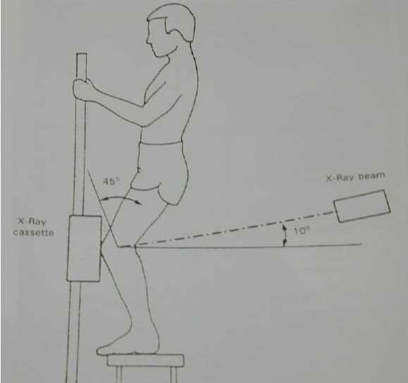 Posición de Rosemberg | Wikia Radiologia | Fandom