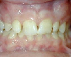 Harry gets braces | Disrespectiods Wiki | Fandom