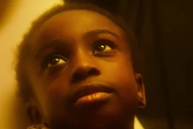 Cherubism Robert Zdar