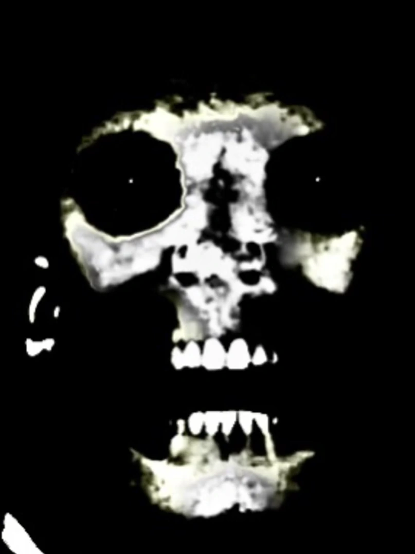 Bobified Face With No Muscles Phase (Slaughterhouse) | The Uncanny ...