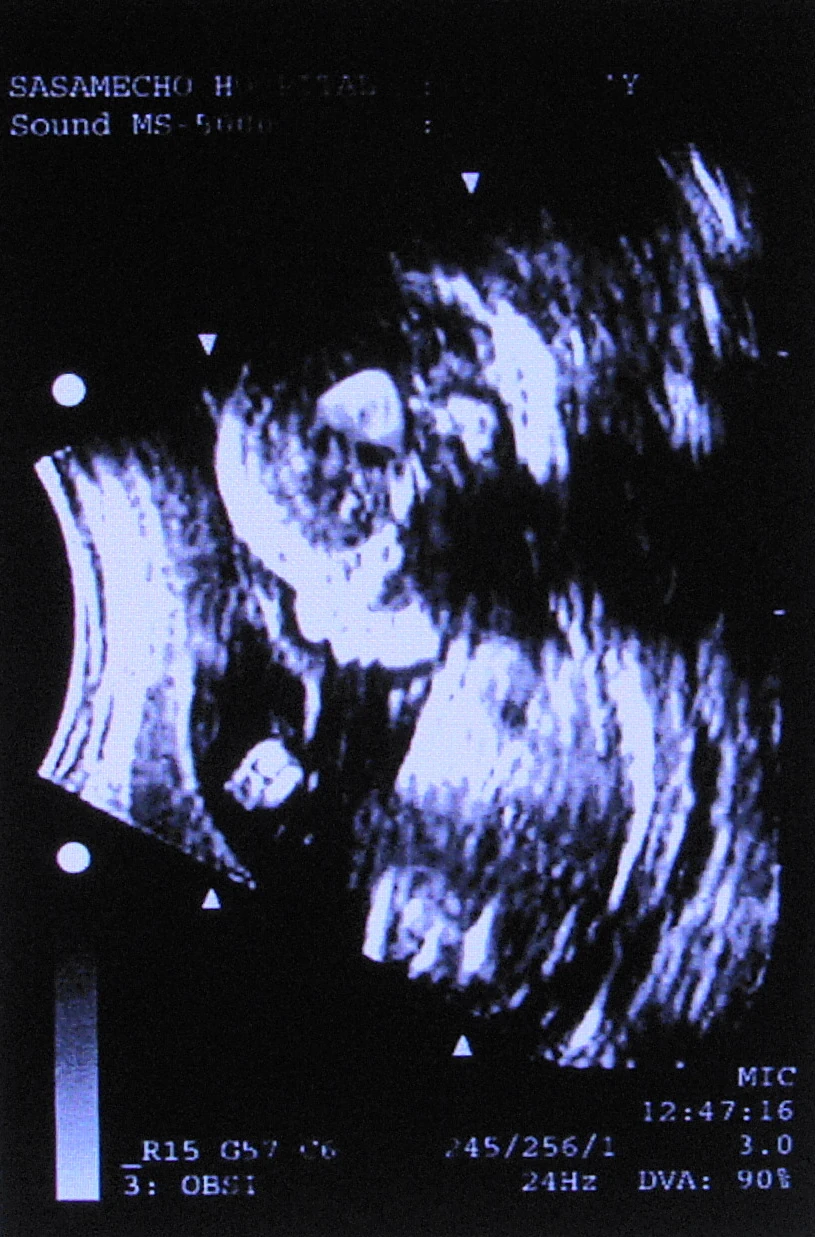 Diclonius (Elfen Lied) | Ultimate Pop Culture Wiki | Fandom