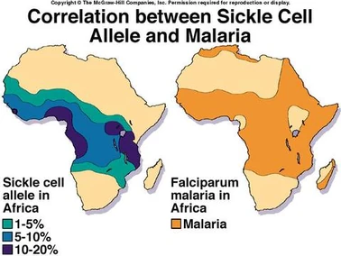 Sickle cell disease | UVM Genetics & Genomics Wiki | Fandom