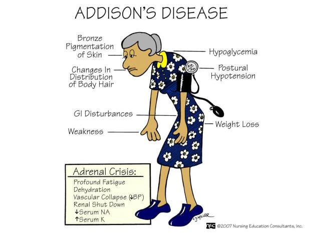 Addison's Disease | Diseases and Their Cures Wikia | Fandom