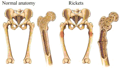 Osteomalacia | Diseases and Their Cures Wikia | Fandom