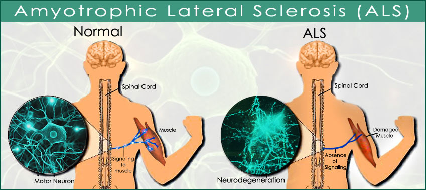 Amyotrophic Lateral Sclerosis (ALS) | Diseases and Their Cures Wikia ...