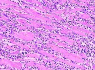 Tissue infarction, tissue repair | VIA Revision Wiki | Fandom