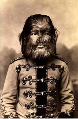 Hypertrichosis | WereWiki | Fandom