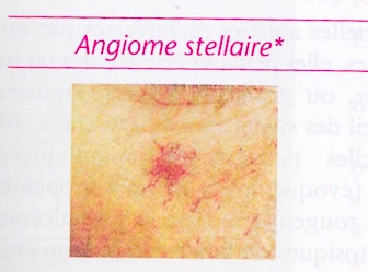 Angiome stellaire | Wikige Wiki | Fandom