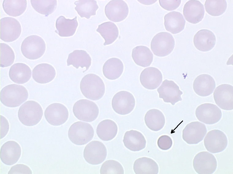 Microsphérocytes | Wikige Wiki | Fandom