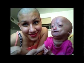 progeria rose