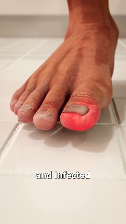 What Is An Ingrown Toenail? 😨 | Zack D. Films Wiki | Fandom