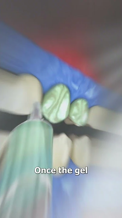 Professional Teeth Whitening 🤔 (explained) | Zack D. Films Wiki | Fandom