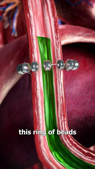 How Beads Stop Acid Reflux 😨 | Zack D. Films Wiki | Fandom