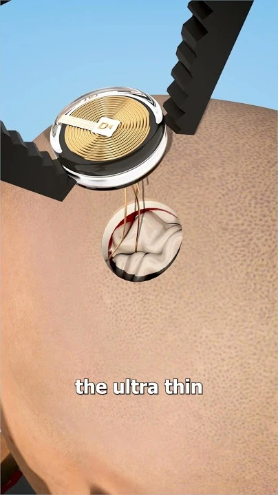 How Neuralink Works 🧠 | Zack D. Films Wiki | Fandom